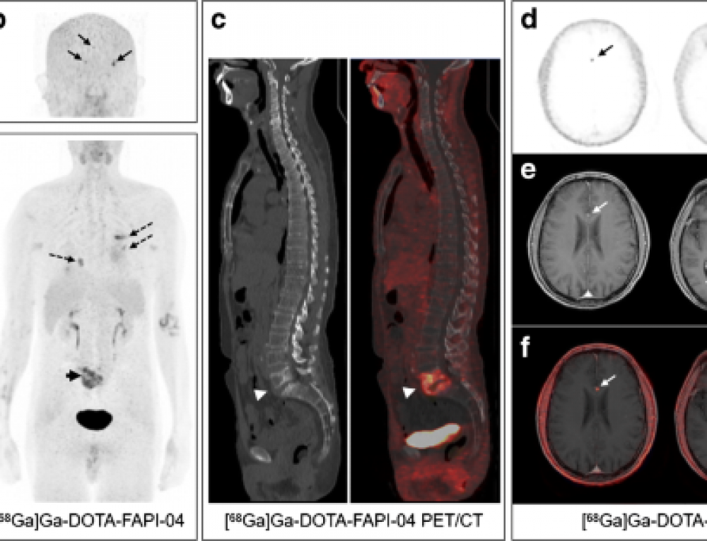 Fibroblast Activation Protein-Targeted PET/CT with 68 Ga-FAPI for ...