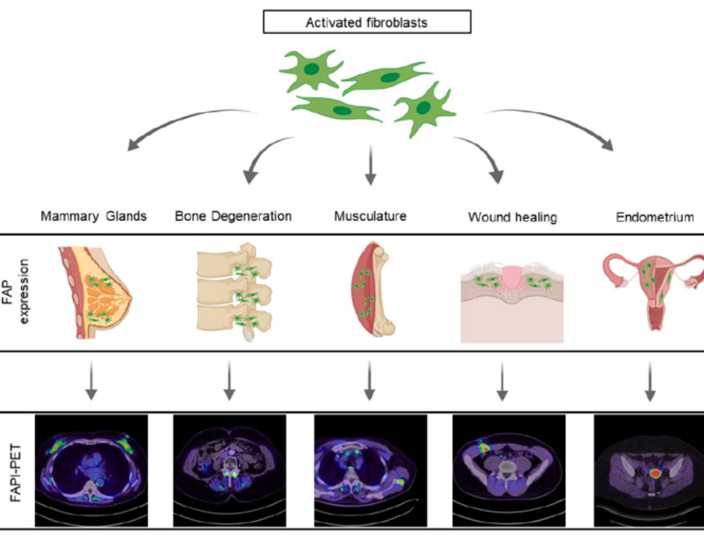 Safety and efficacy of 90Y-FAPI-46 radioligand therapy in patients with advanced sarcoma and ...