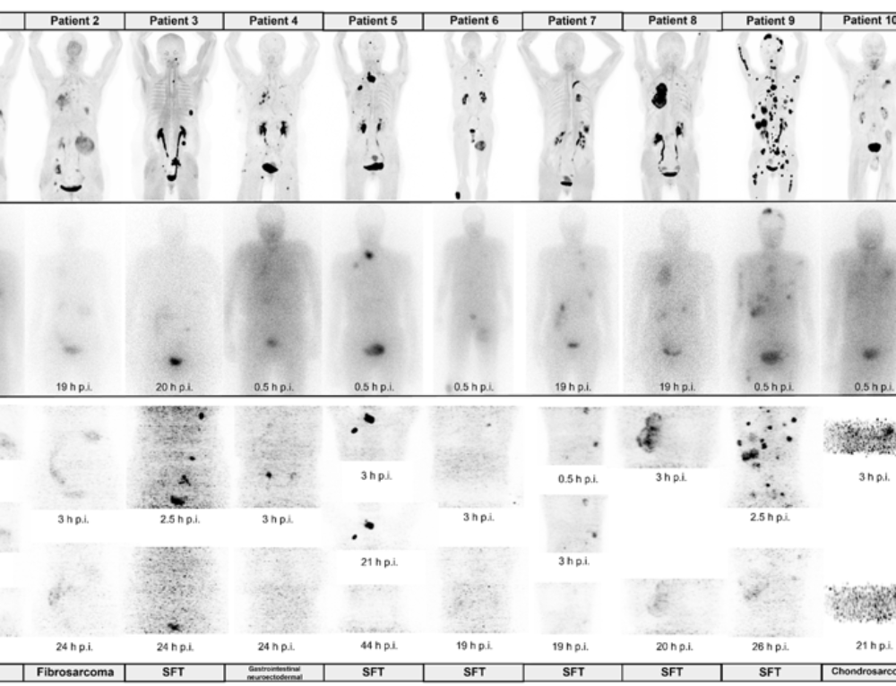 FAPI-74 PET/CT Using Either 18 F-AlF or Cold-Kit 68 Ga Labeling ...