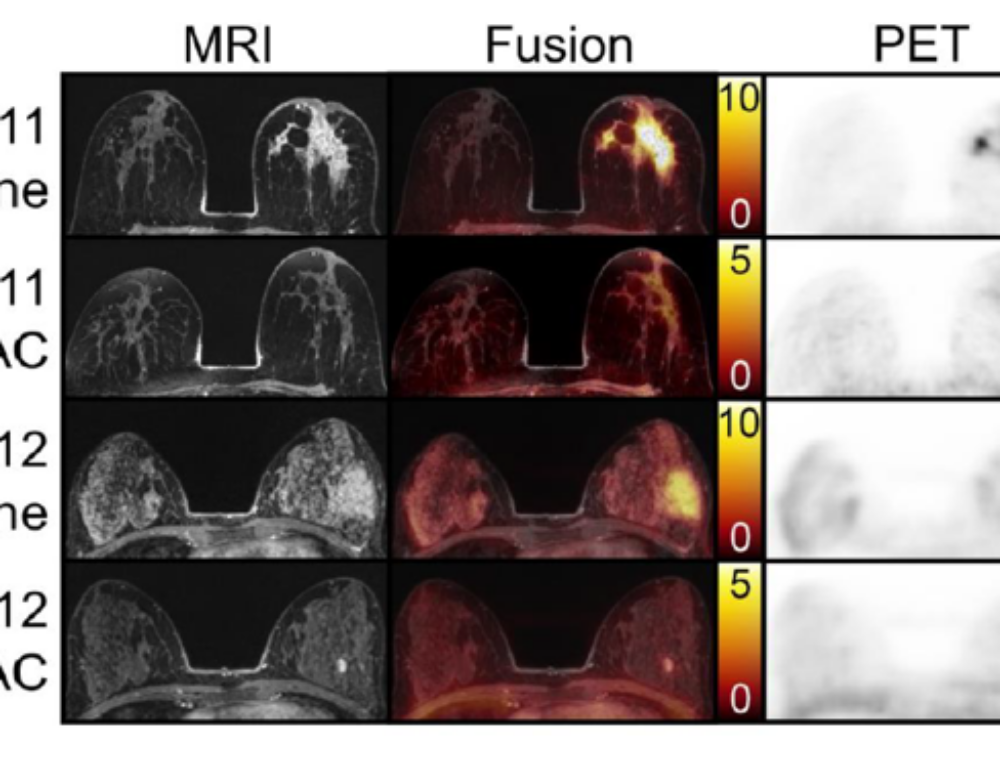 FAPI-74 PET/CT Using Either 18 F-AlF or Cold-Kit 68 Ga Labeling ...