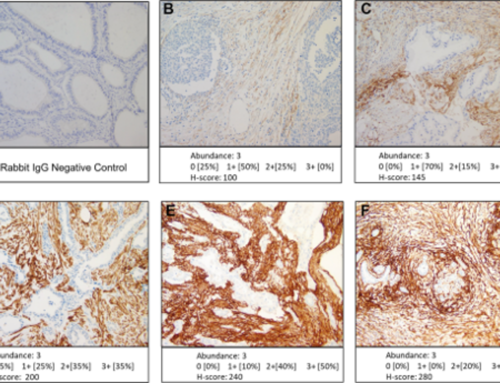 FAPI PET: Fibroblast Activation Protein Inhibitor Use in Oncologic and ...