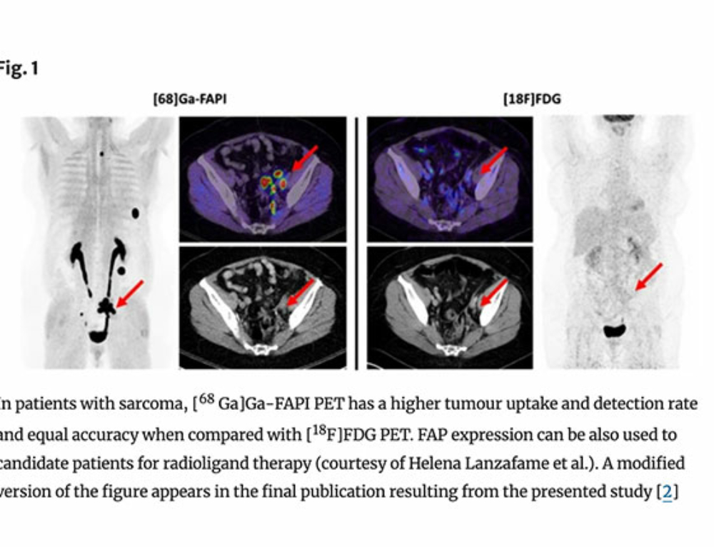 FAPI PET: Fibroblast Activation Protein Inhibitor Use in Oncologic and ...